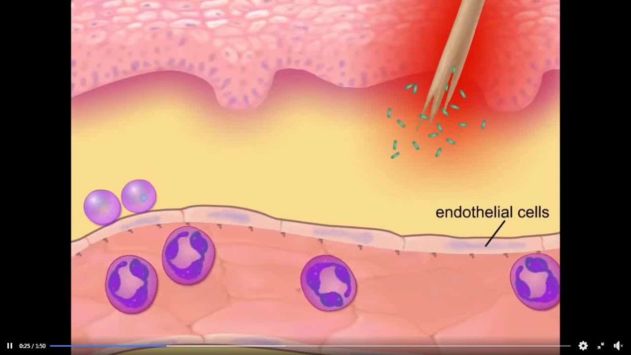 INFLAMACIÓN AGUDA CLASIFICACIÓN SEGÚN EXUDADO - YouTube