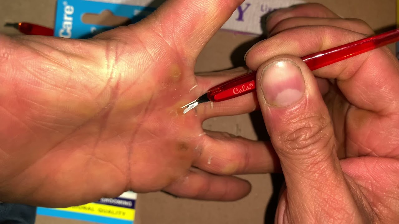 Elimina callos de las manos por entrenar.!! - YouTube