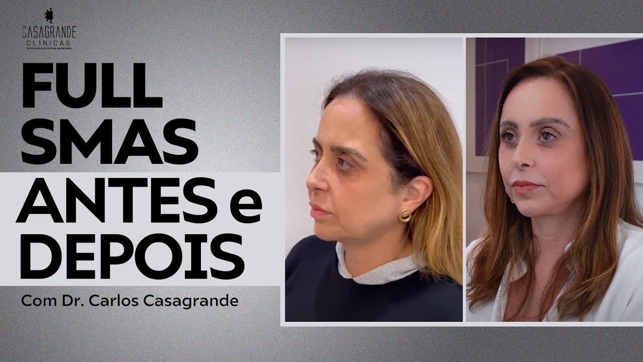A TRANSFORMAÇÃO do FULL SMAS que devolve A AUTOESTIMA EM DIAS - ANTES E ...