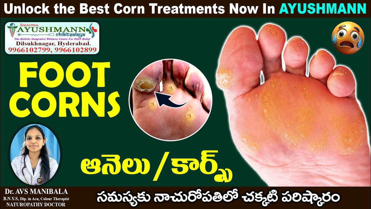 Unlock the Best Corn Treatments with Naturopathy,Ayurveda,Homeopathy at ...