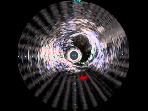 Volcano Corporation Therapeutics Pioneer Plus Catheter - IVUS Run - YouTube