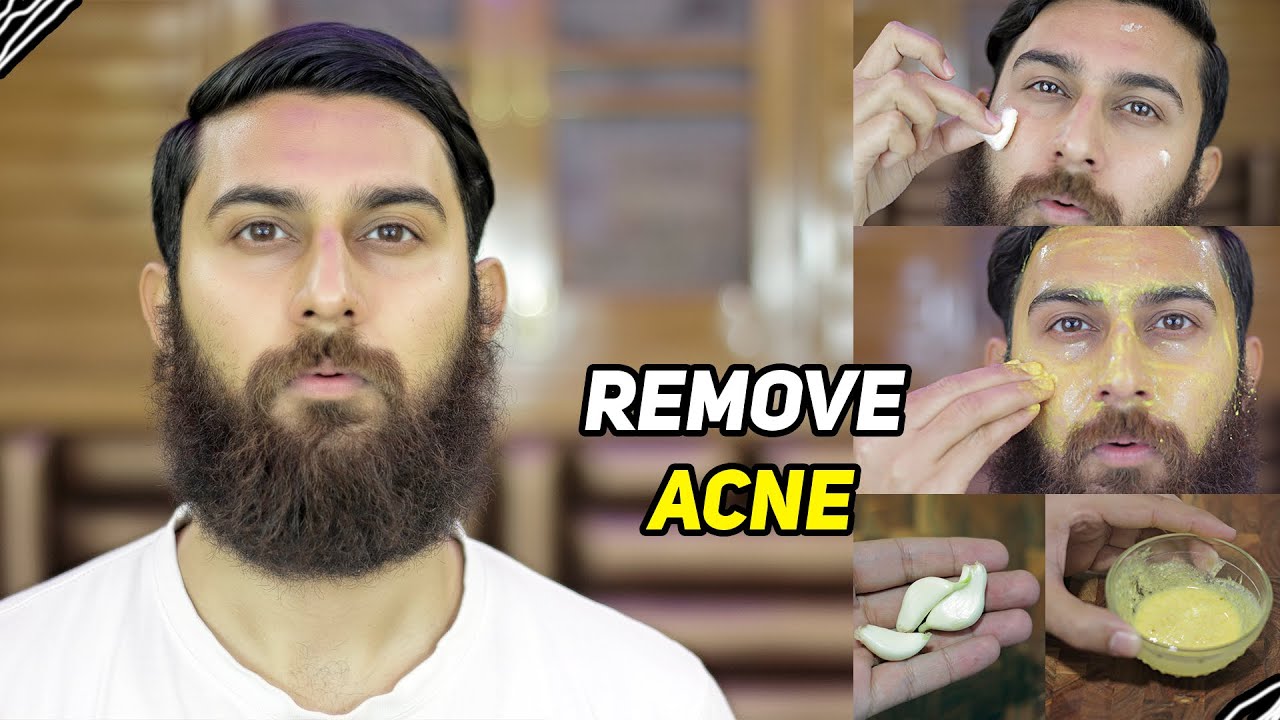 Remove Acne at Home Naturally | 4 Remedies For Pimples & Acne - YouTube
