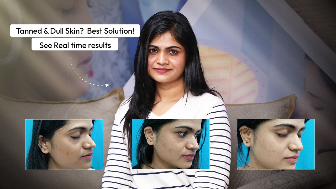 Say Goodbye to Tan & Dull Skin! | #VCare Yellow peel treatment ...