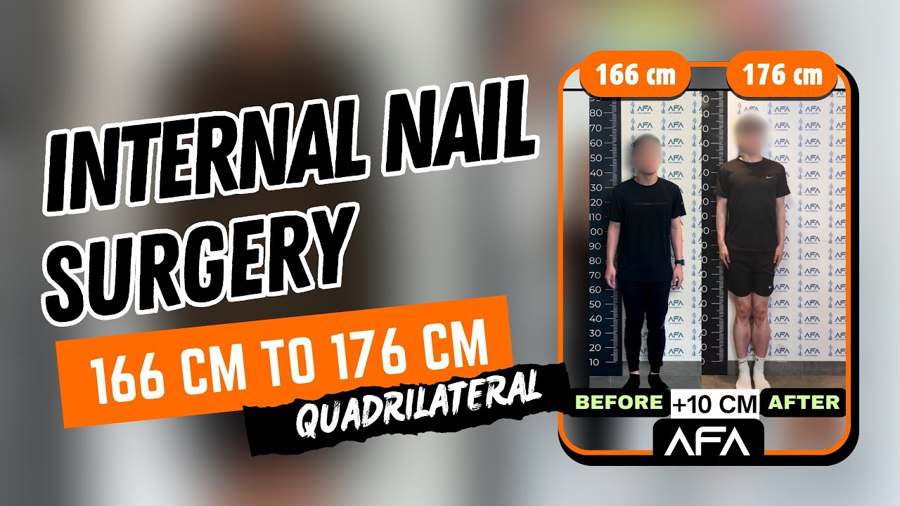 FROM 166 CM TO 176 CM: Time for Internal Nail Surgery! - YouTube