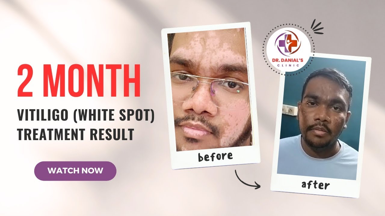 2 Months: Before and After Patient Review | Vitiligo Transformation ...