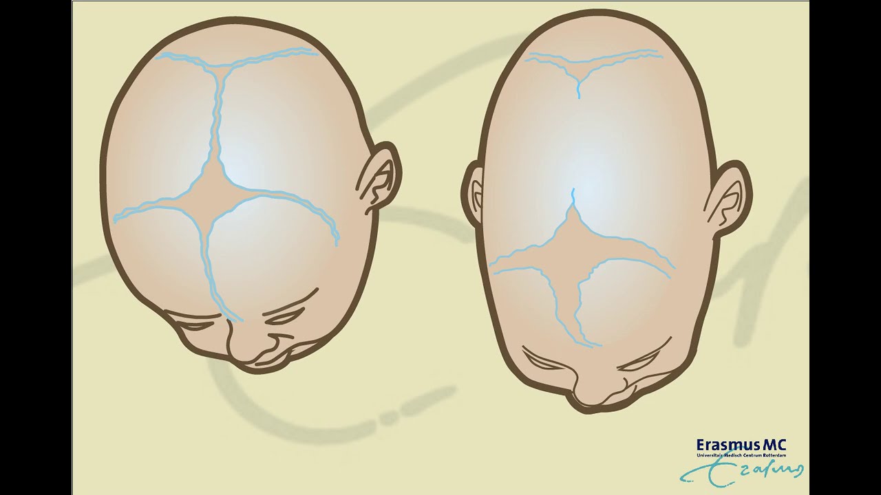 Veerdistractie bij een bootschedel of Scaphocephalie - YouTube