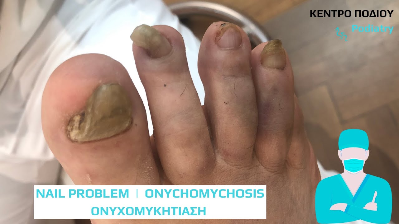 Nails|Fungal Nail treatment|Ονυχομυκητίαση|Ποδιατρική Ποδολογία|Κέντρο ...
