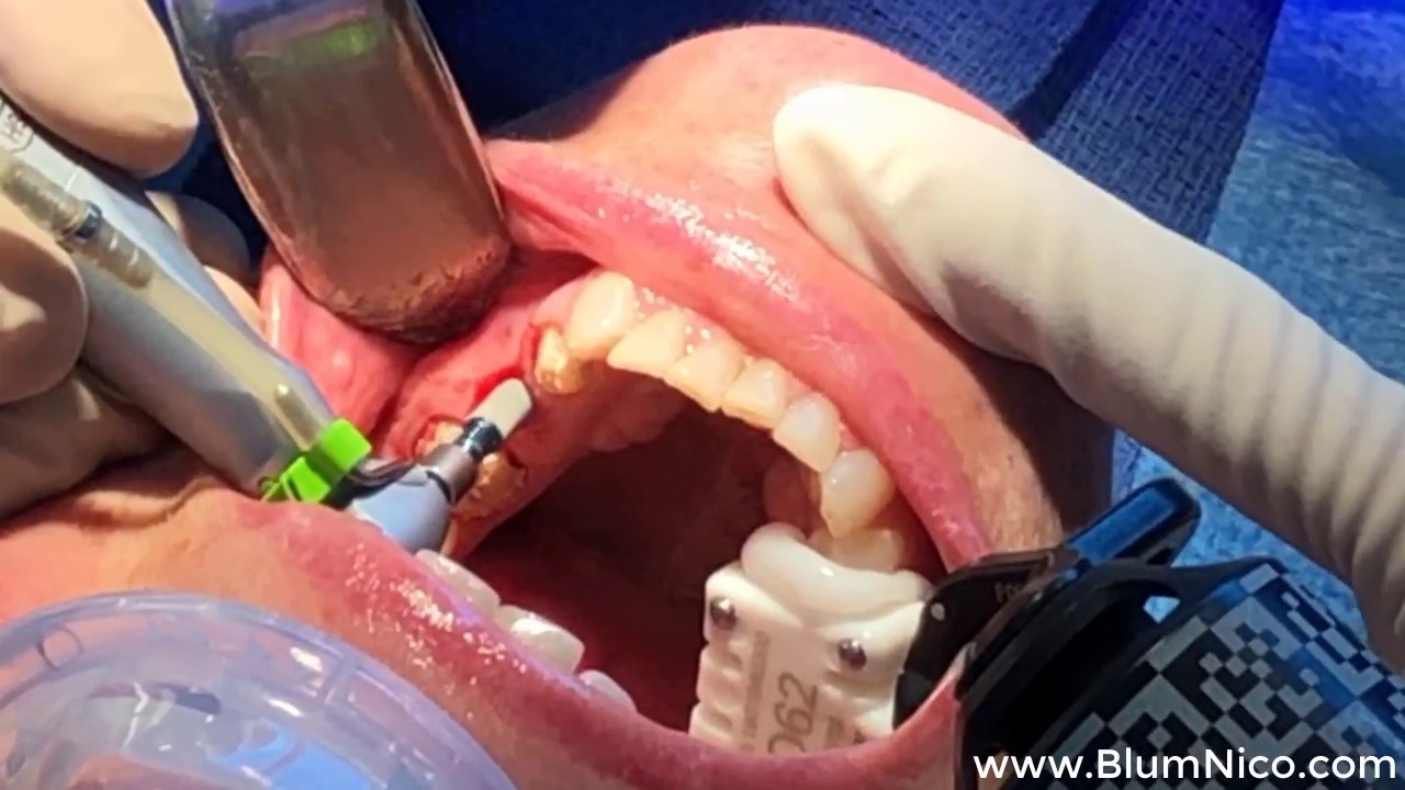 Dental Implants with the X-NAV 3-D Guided System: Miami Oral Surgeons ...