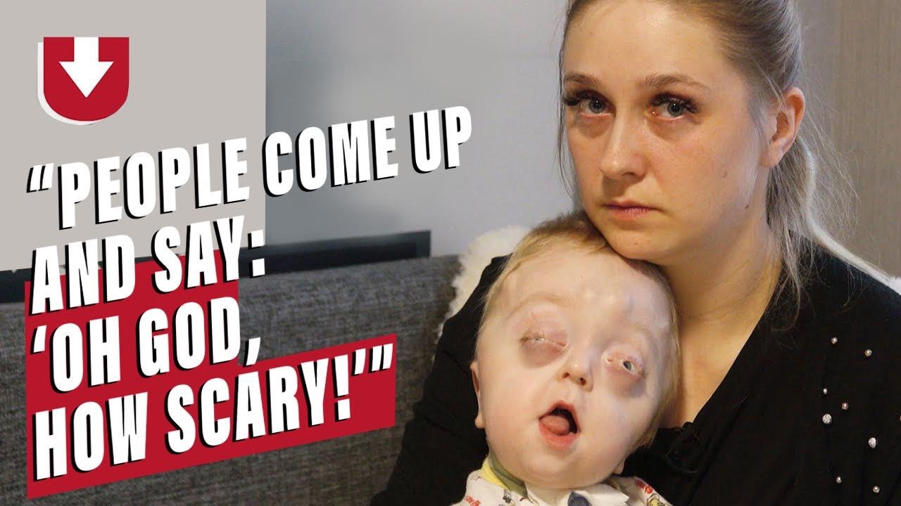 My Son Has Pfeiffer Syndrome: Katya's Journey | Being a Mom - YouTube