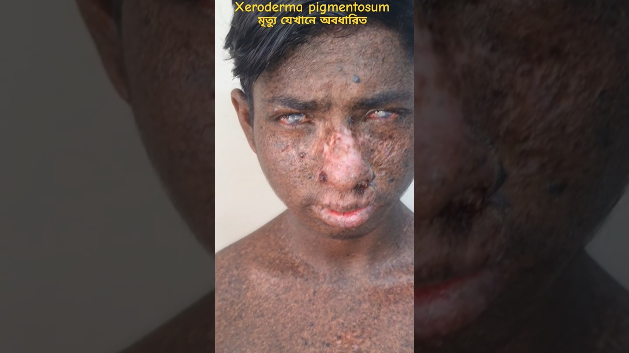 Xeroderma Pigmentosum: এক বিরল ত্বকের রোগ#drmuradhossain - YouTube