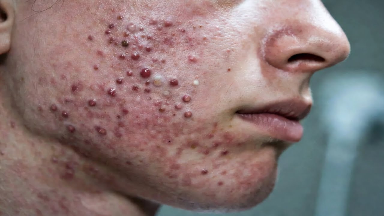 Expert Skin Extraction Cystic Acne Treatment & Deep Pore Cleaning - YouTube
