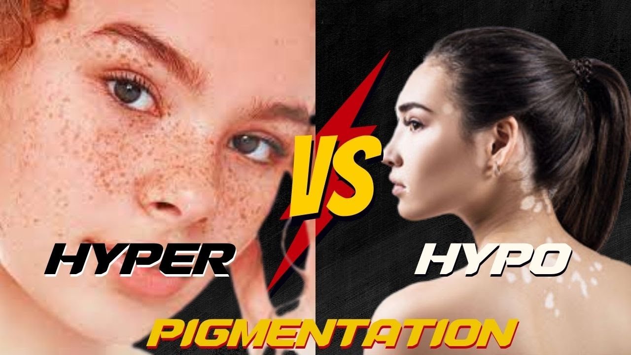 Hyper & Hypo Pigmentation |Dr.Gayathri Rajesh |Dermatologist ...