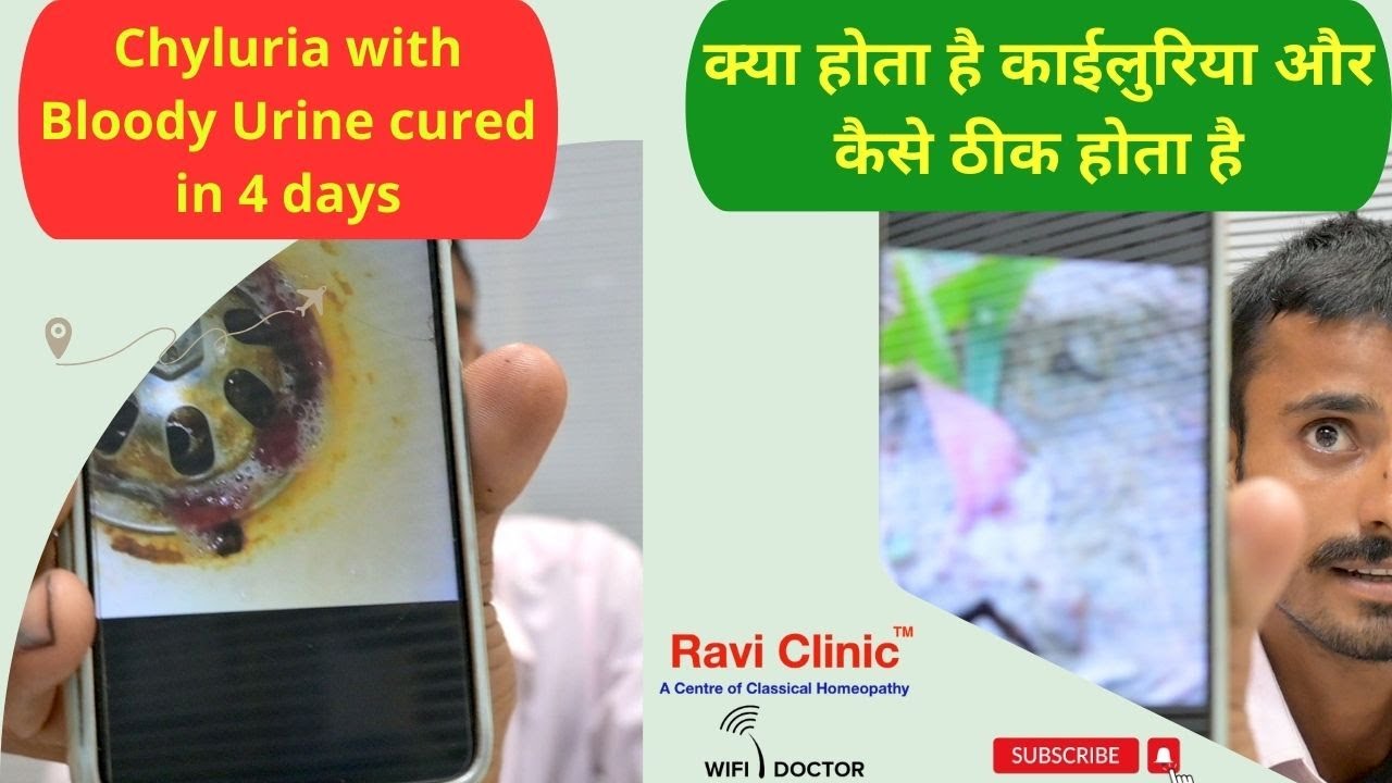 Chyluria with Milky and Bloody Urine got cured in 4 days - Dr Ravi ...