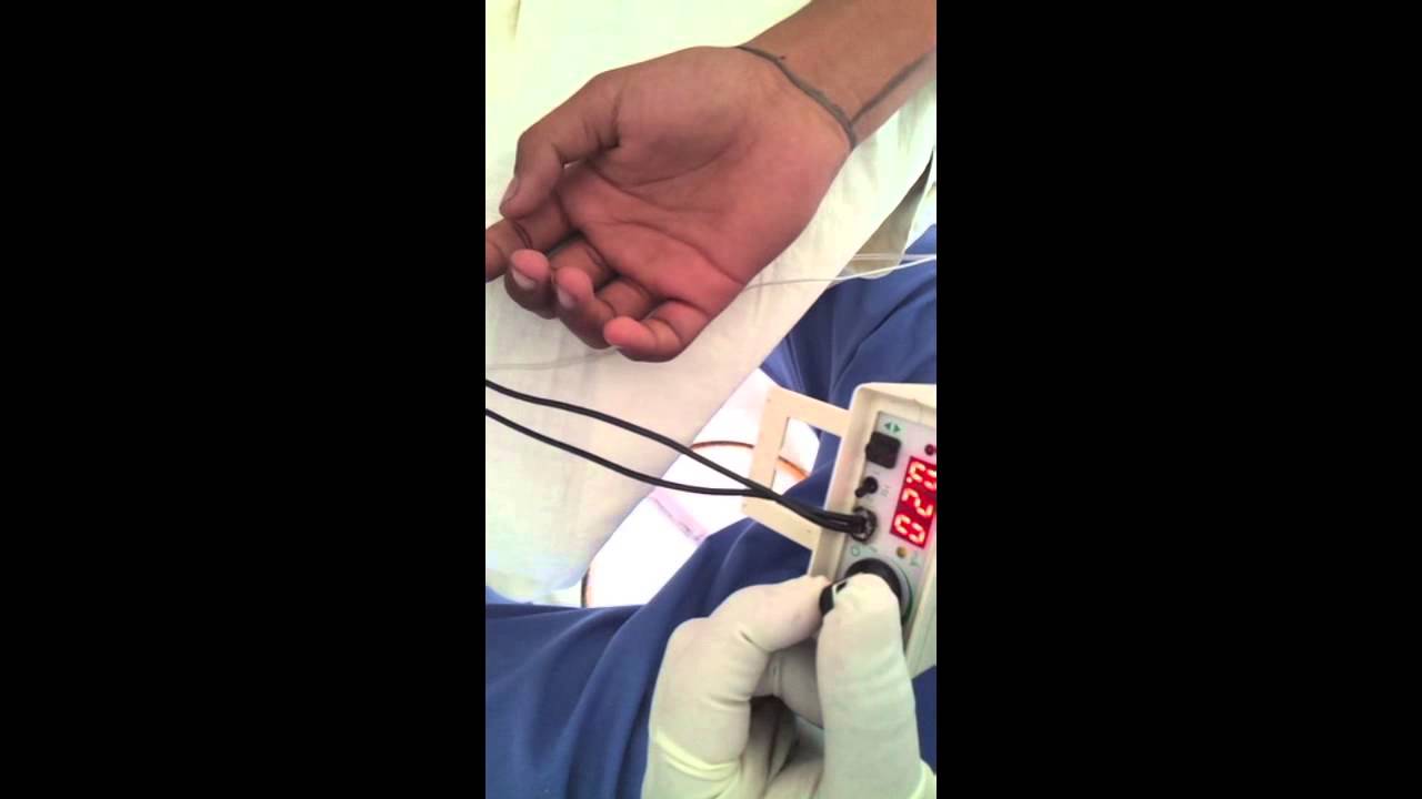 ULNAR NERVE BLOCK AT THE LEVEL OF WRIST - YouTube