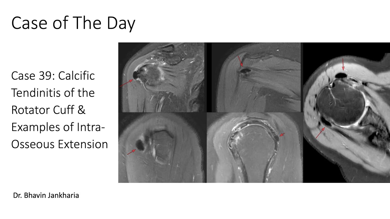 Case of the Day - 039 - 2025 05 21 - Calcific Tendinitis Rotator Cuff ...