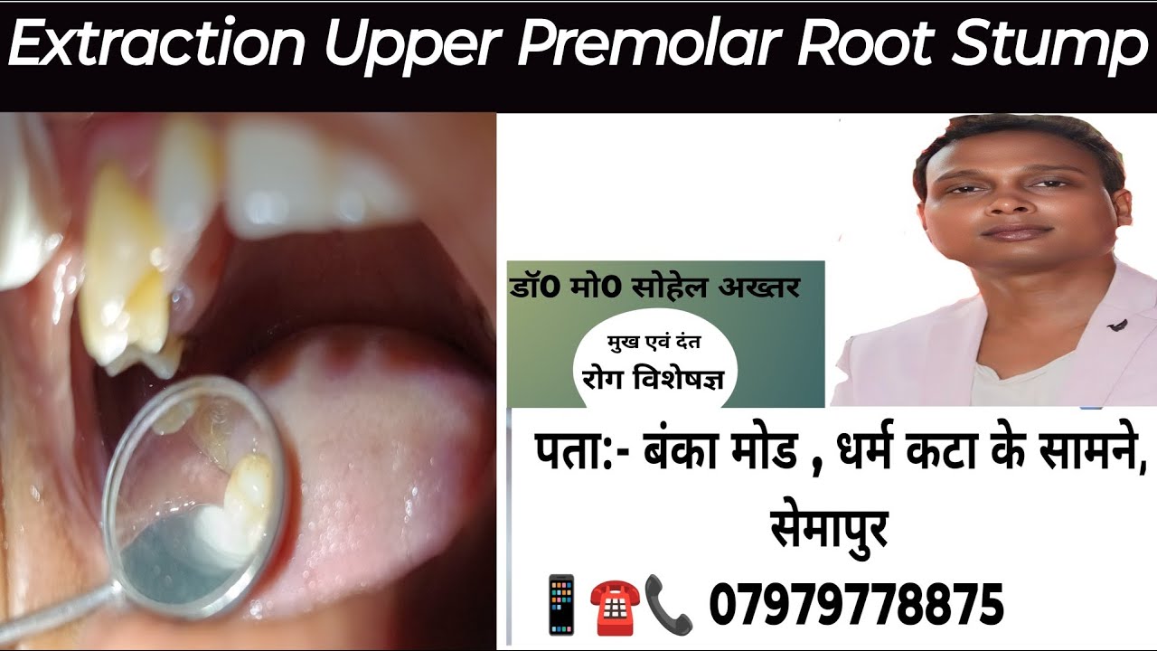 Extraction Upper Premolar Root Stump || Upper Root Stump Extraction ...