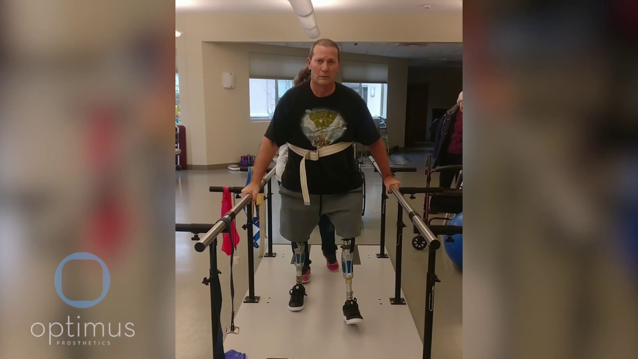 Motivated Bilateral Amputee Learns to Walk on His New Permanent ...