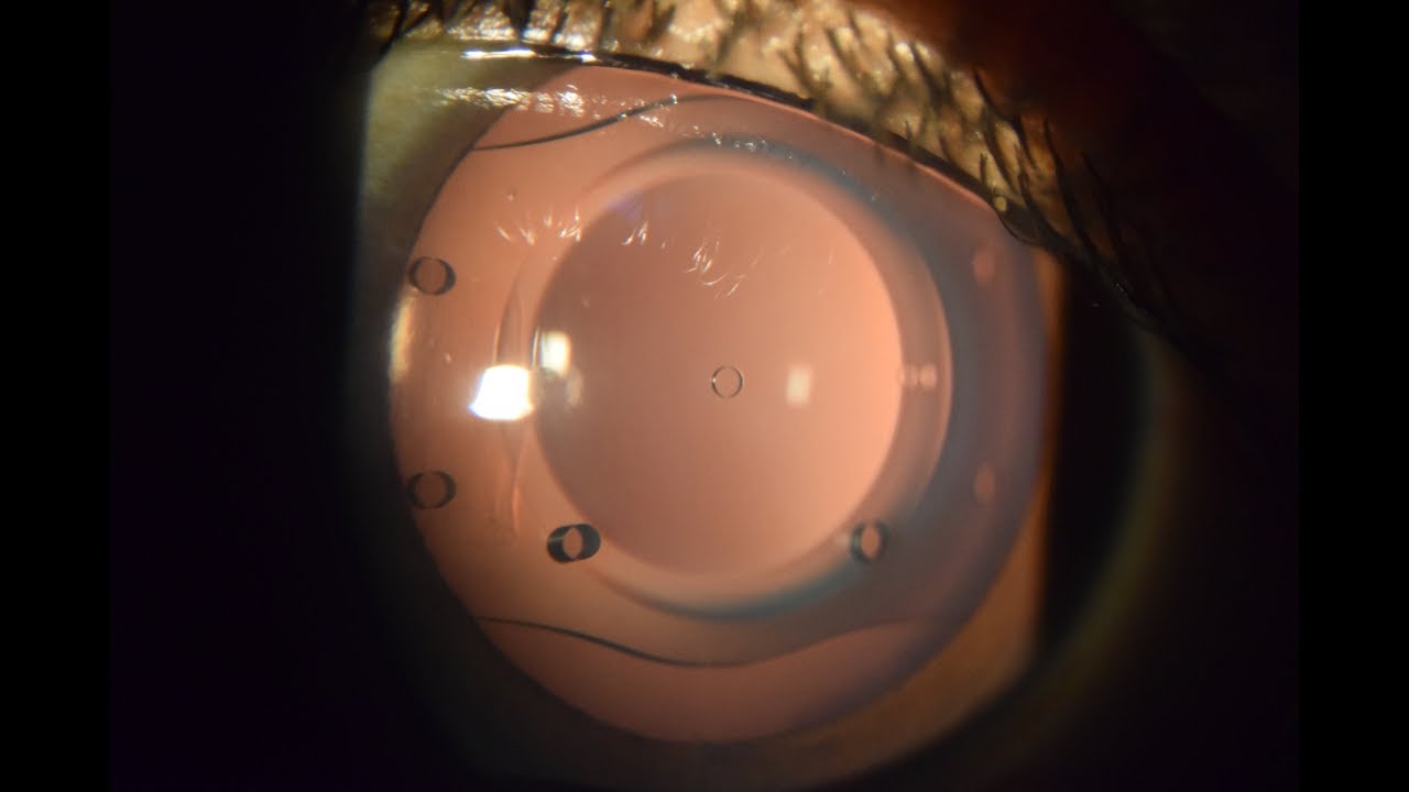 Toric IPCL: Phakic IOL by Dr Siddiq, Vision Eye Hospital, Dhaka - YouTube