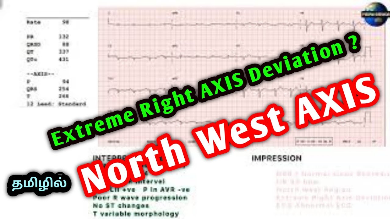 ECG -5 North West Axis Deviation - YouTube