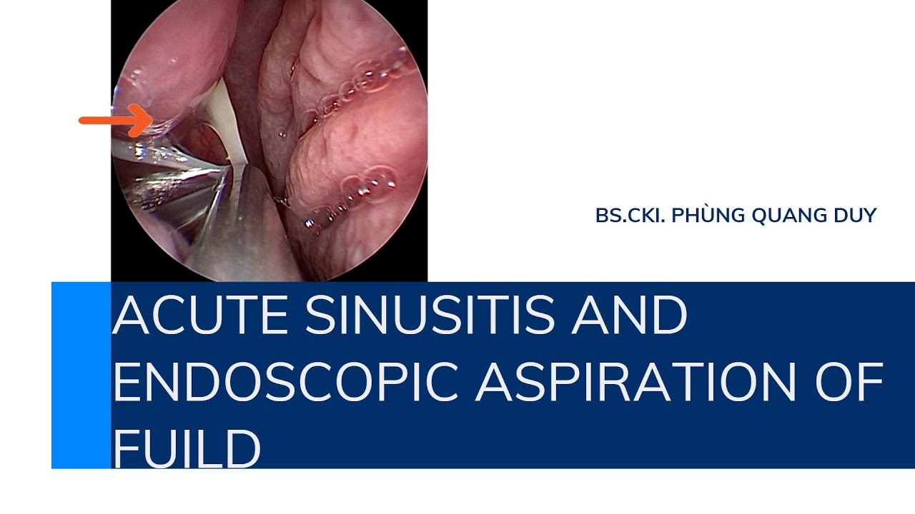 ACUTE SINUSITIS AND ENDOSCOPIC ASPIRATION OF FUILD - VIÊM XOANG CẤP VÀ ...