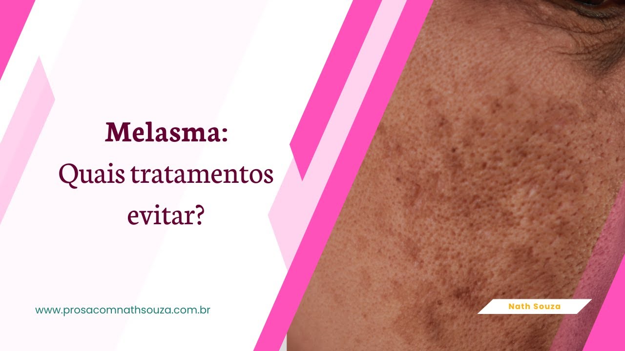 Melasma: Quais procedimentos evitar? - YouTube
