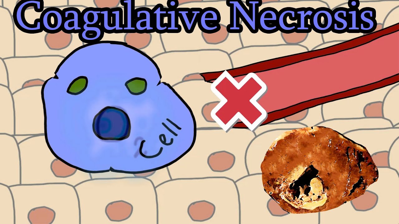 Coagulation Necrosis