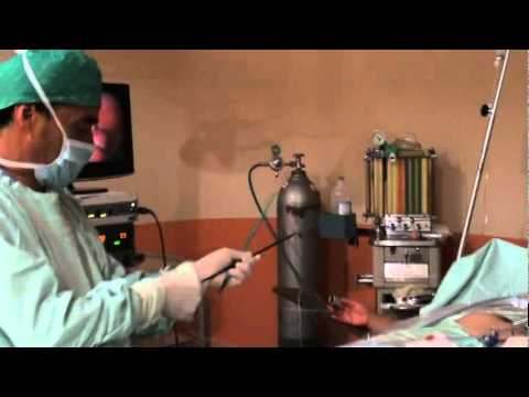 OPERACION DEL APENDICE VIA VIDEOLAPAROSCOPICA - YouTube
