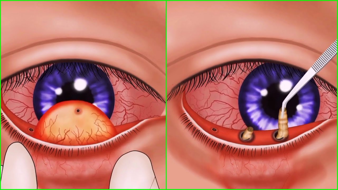 ASMR Eye Conjunctivitis Infection Animation | Eye Treatment | Rheum ...