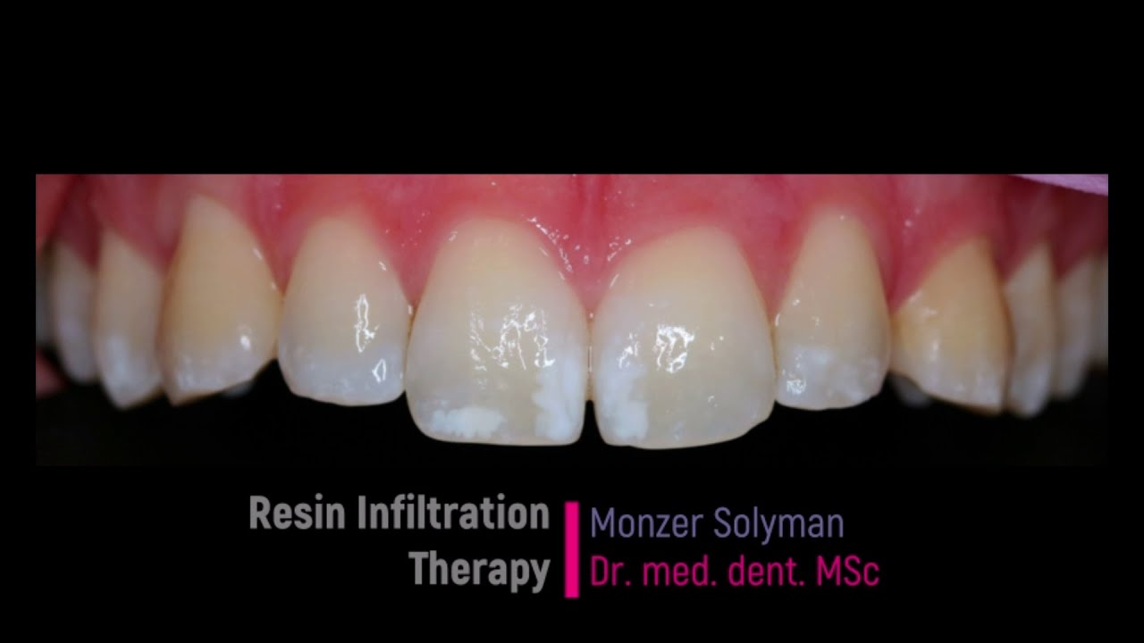 Resin Infiltration Therapy with ICON for White Spot Lesions - YouTube
