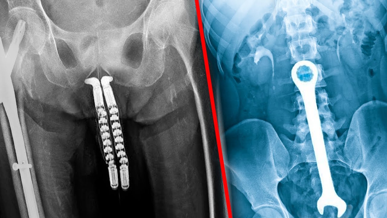 Most BIZARRE Things Found By X-Rays! - YouTube