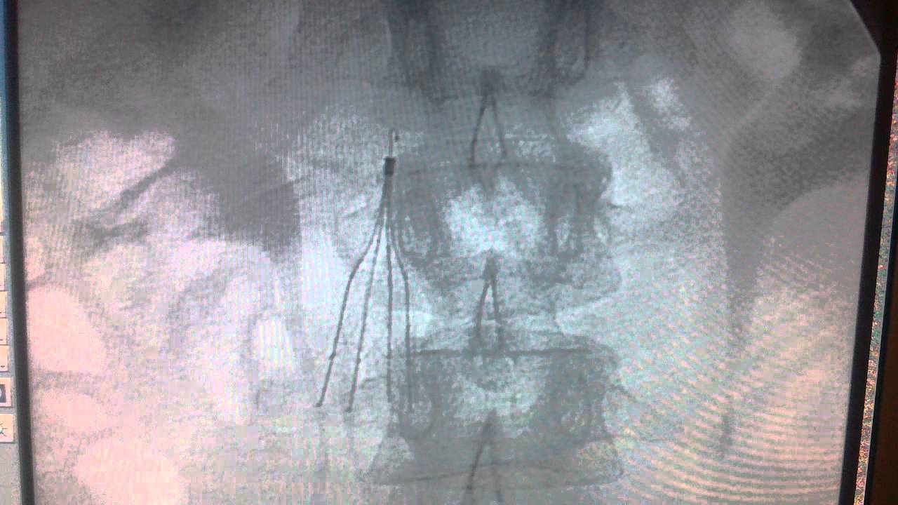 Filtro de Vena Cava Inferior - YouTube