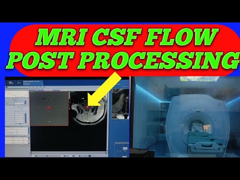MRI BRAIN CSF FLOW POST PROCESSING @MRI CSF FLOW PROCESSING @CSF FLOW MRI STUDY @MRI CSF FLOW STUDY