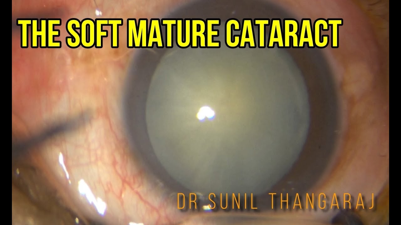 Handling the soft mature cataract - YouTube