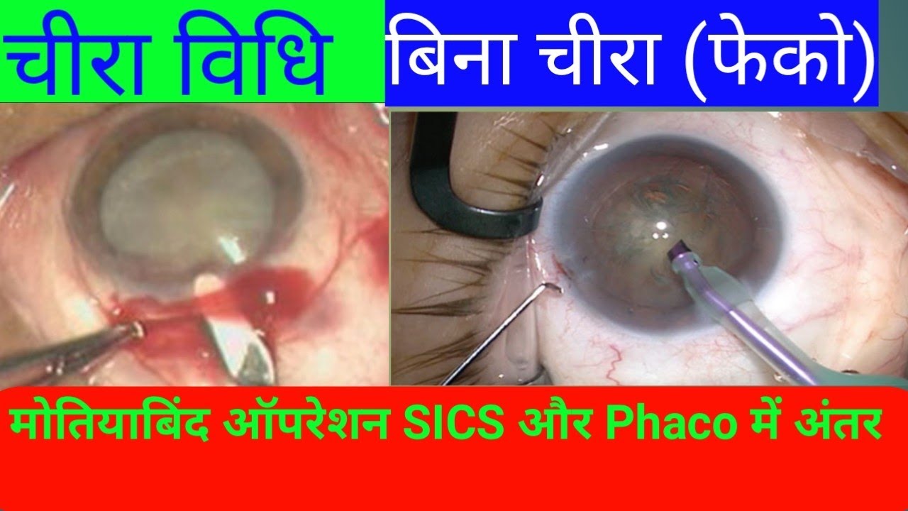 Cataract Surgery Different SICS and Phaco। मोतियाबिंद ऑपरेशन SICS और ...