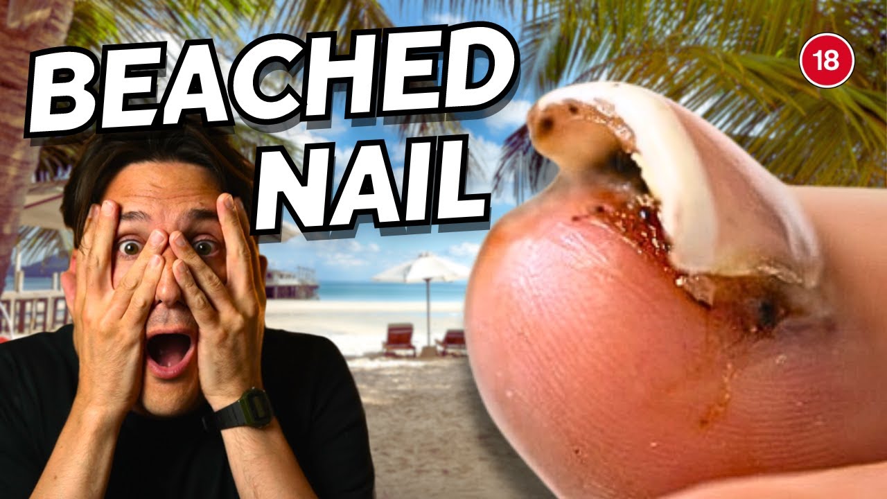 Toenail Removal After Beach Injury: Step-by-Step Procedure & Care Tips ...