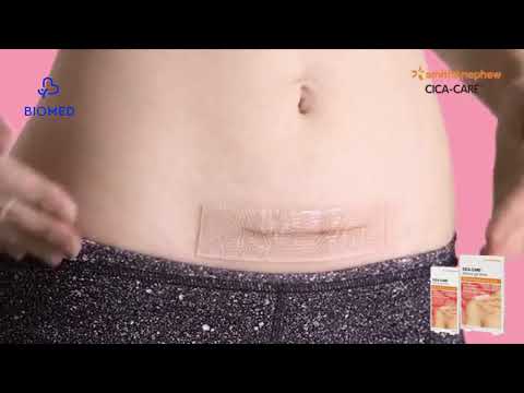 Cica-Care Silicone Gel Sheet | Smith & Nephew Scar & Keloid Treatment