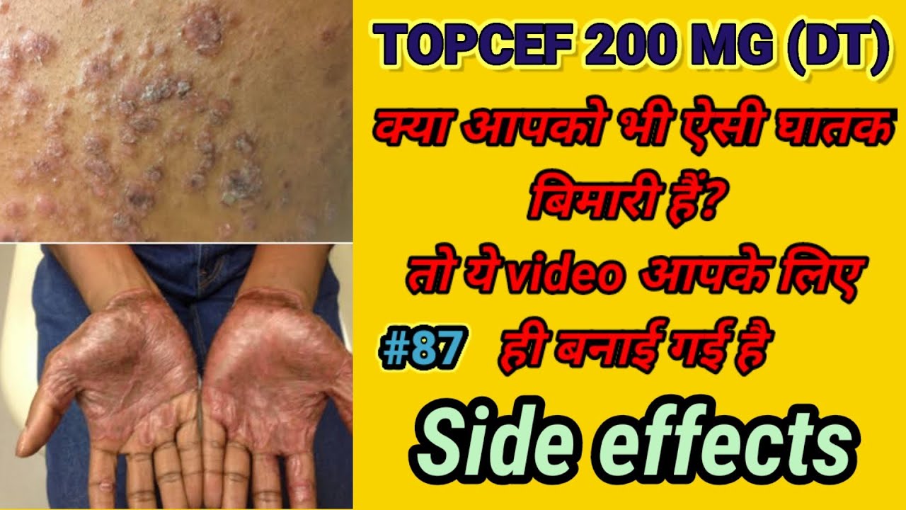 Topcef 200 mg dt tablet | Cefixime 200 | pneumonia, uti, nasal sinus ...