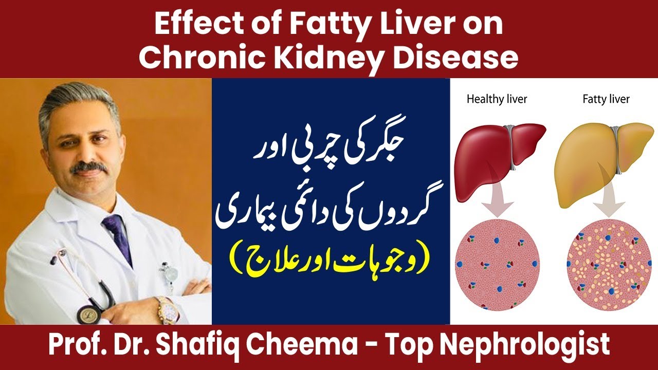 Effect of Fatty Liver on Kidneys | CKD & NASH causes, symptoms and ...