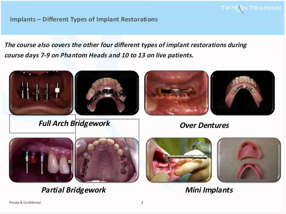 Tipton Training- One Year Implant Course Overview - YouTube