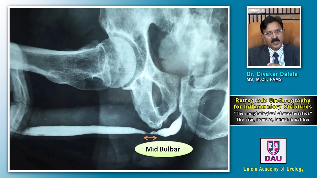 Lect 9 RGU Morphological characteristics Inflammatory strictures - YouTube