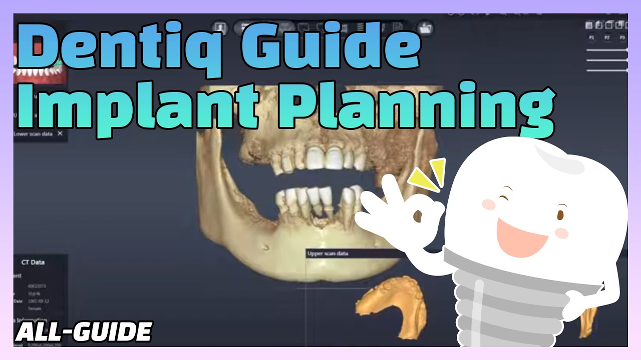ALL-GUIDE Dentiq Guide Implant Planning - YouTube