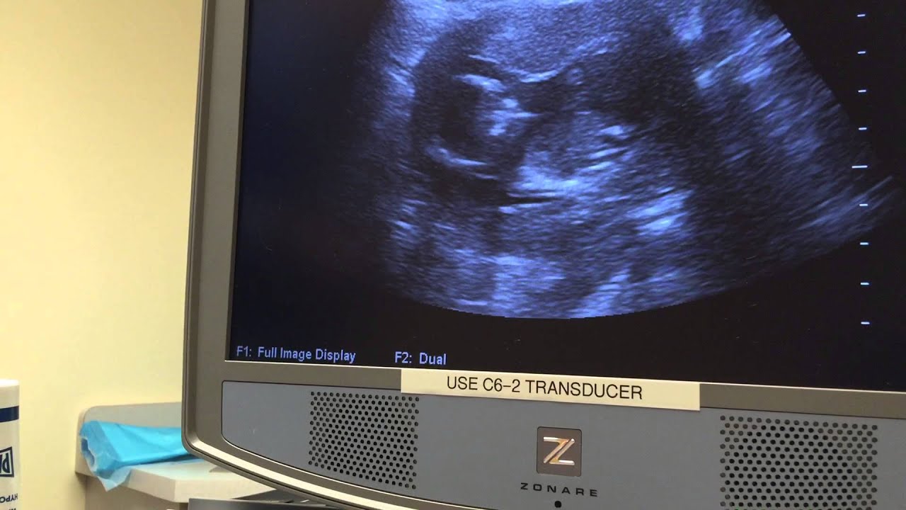 Stud pregnancy 13 week ultrasound - YouTube