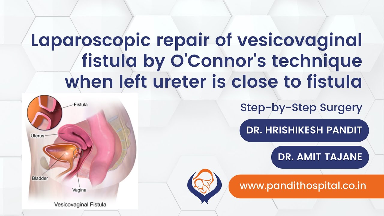 Laparoscopic repair of vesicovaginal fistula by O'Connor's technique ...