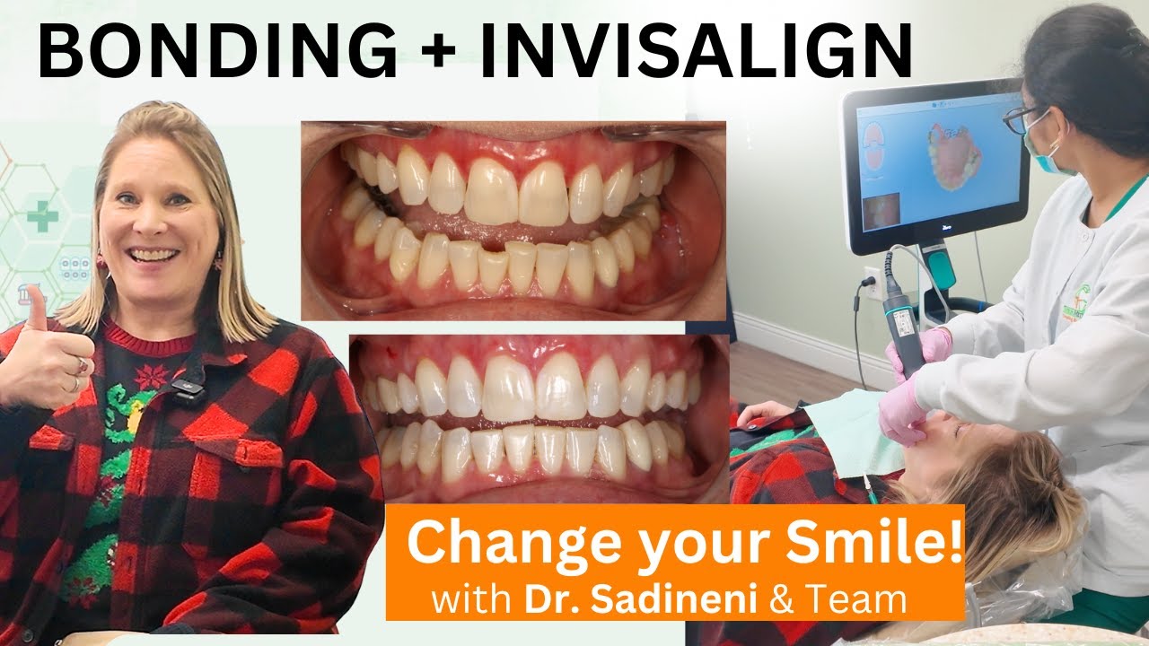 Wendy's Smile Step by Step through Bonding & Invisalign in Columbus ...