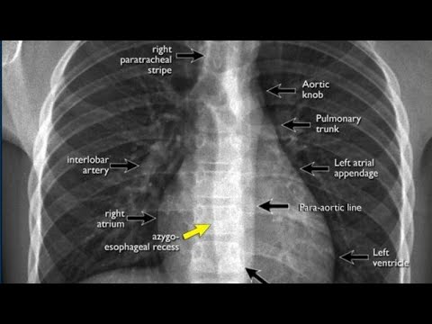 PAEDS CHEST FRCR MCQS - YouTube