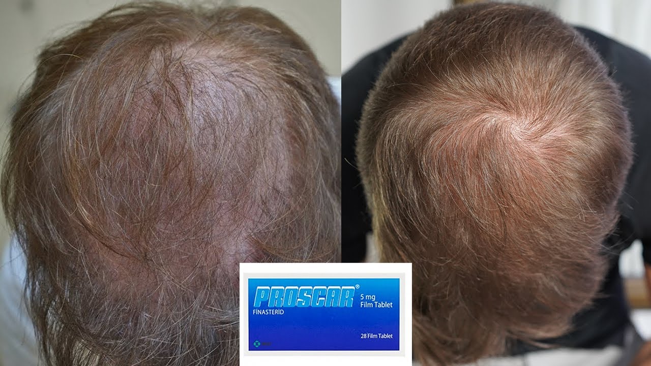 2 years on Finasteride UPDATE!!! - YouTube