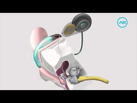 Koklear İmplant Nasıl Çalışır