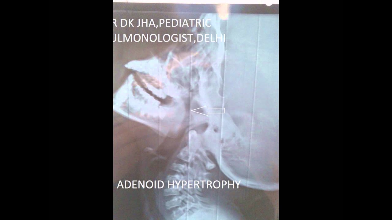 Adenoid Hypertrophy X Ray