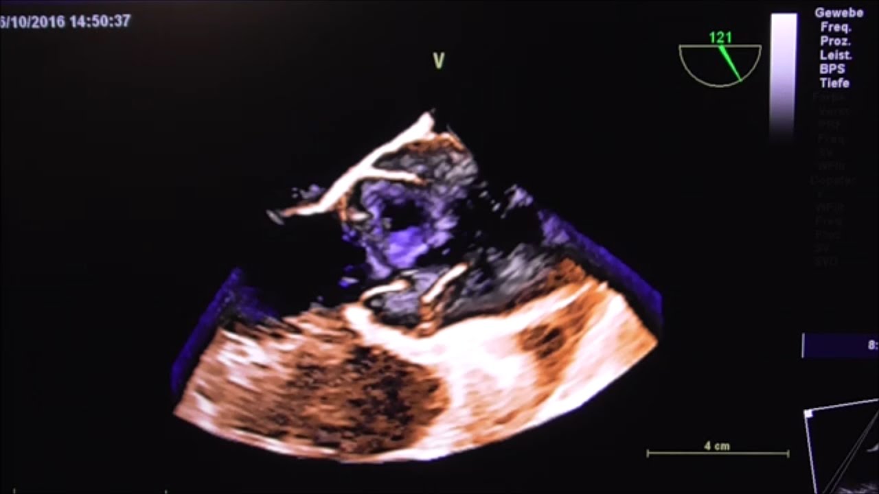 Standford A dissection (DeBakey type II) - YouTube