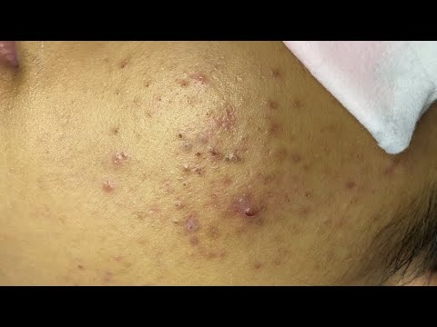 Relax everyday with Linh My Dang - Big Blackheads - Blue T-shirt boy ...